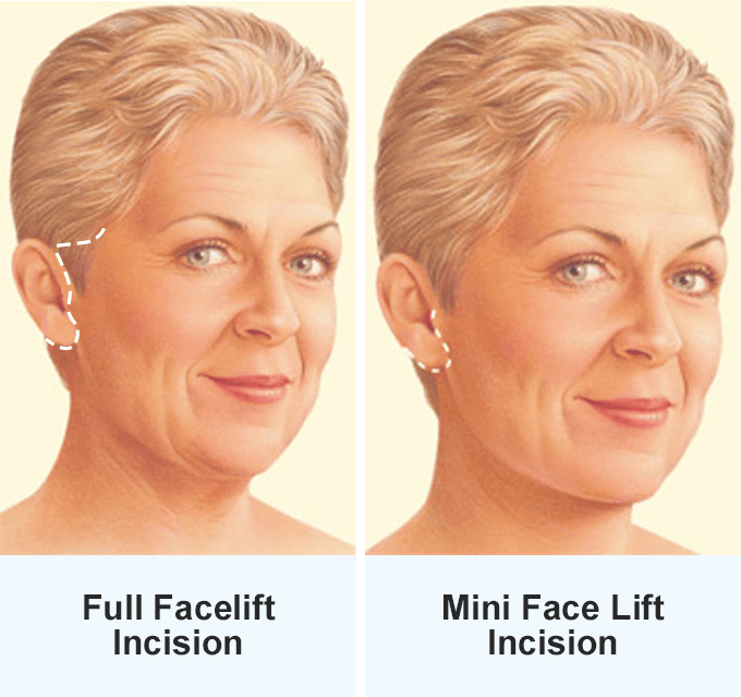 Facelift in Chicago – TLKM Plastic Surgery