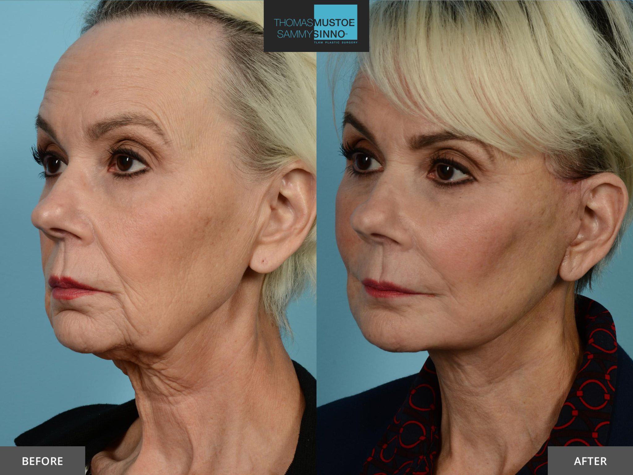 Facelift Before and After Photos Prove Just How Natural Today’s Results ...
